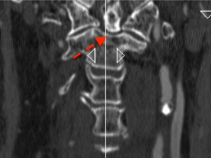 Fractura de odontoides – José Vicente Mollá Torró