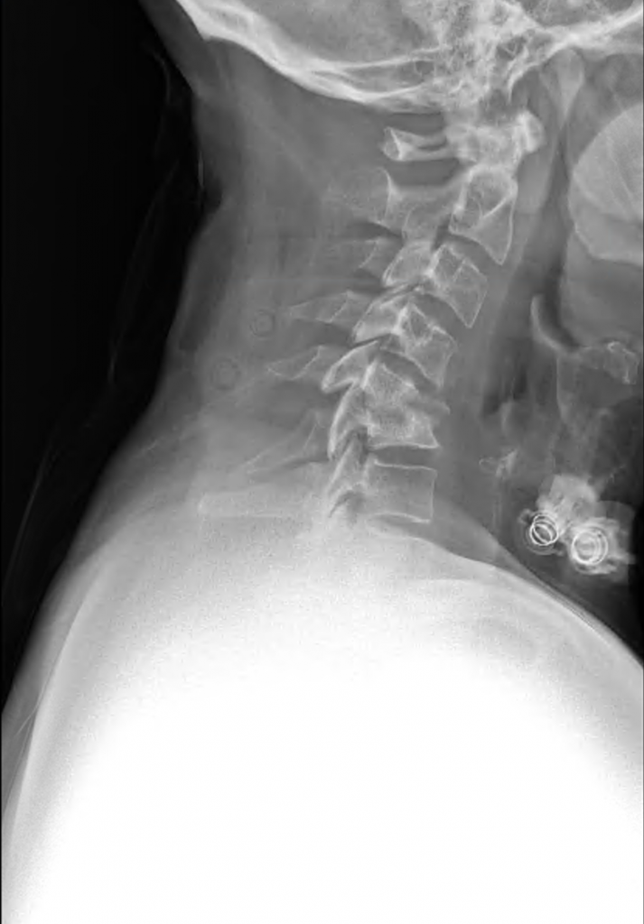 Espondilodiscitis cervical postraumática – José Vicente Mollá Torró