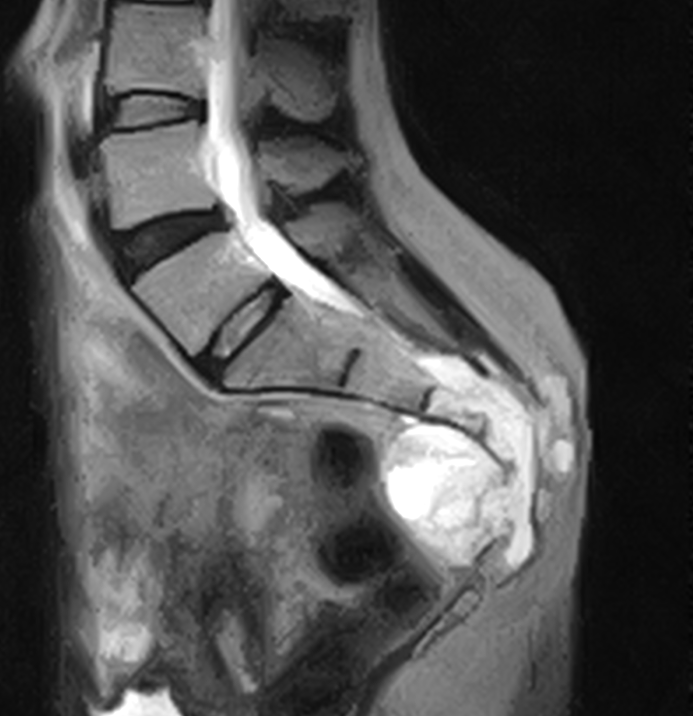 Cordoma sacrococcígeo – José Vicente Mollá Torró